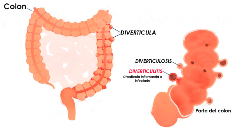 Diverticulosis y diverticulitis, ¿qué debo saber? - HLA Vistahermosa